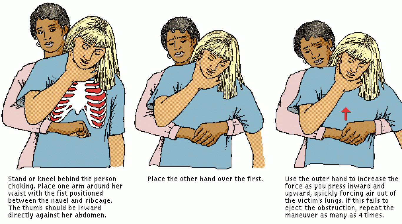 Meghalt Dr. Henry Heimlich, a Heimlich-féle műfogás megalkotója